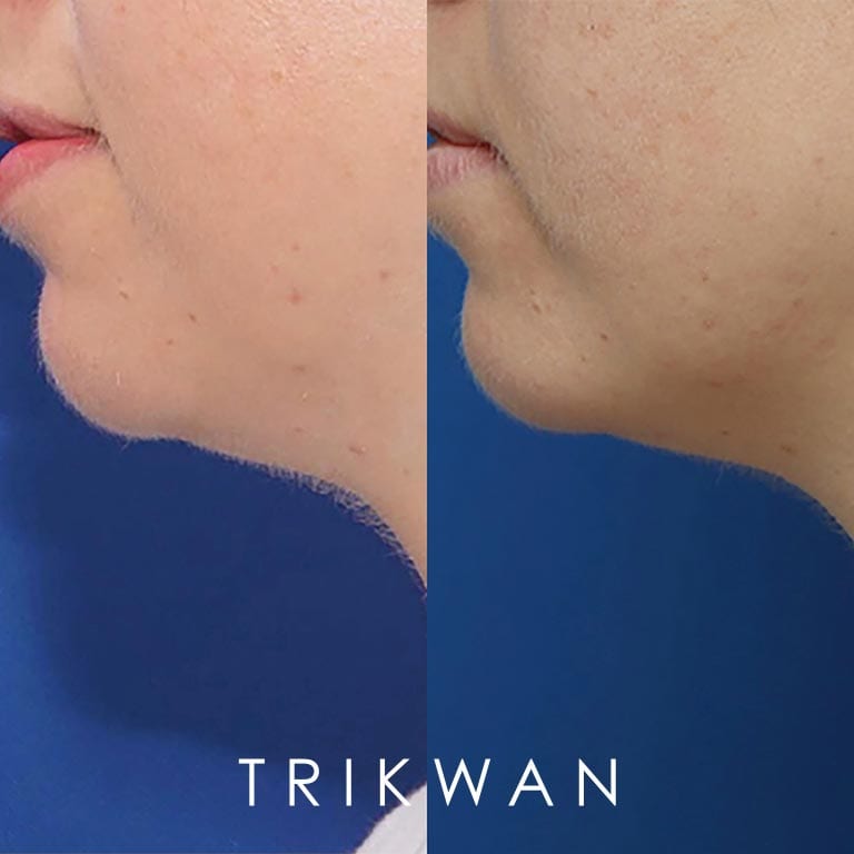 Morpheus 8 | TRIKWAN Aesthetics | Skin Resurfacing and Fat Reduction