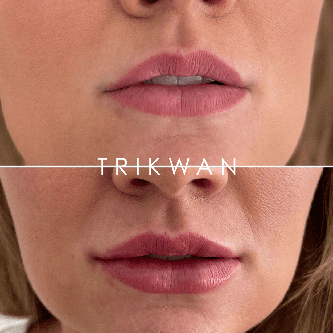 Why should you avoid the Lip Flip? - TRIKWAN - Mayfair London