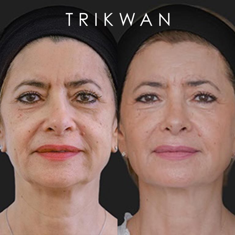 Ellanse | TRIKWAN Aesthetics | Treatment For Fine Lines Mayfair