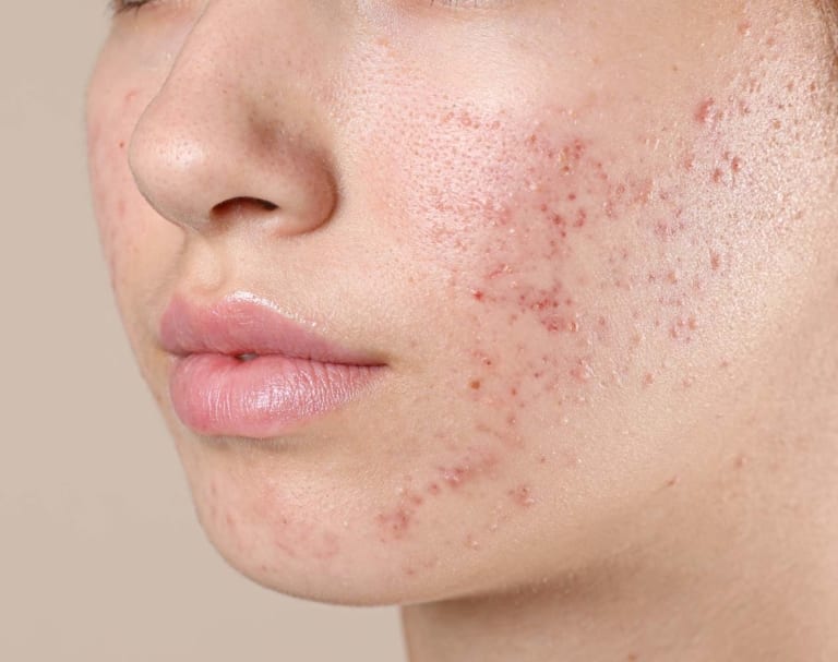 Acne | TRIKWAN Aesthetics | Obagi Skincare Treatment Harley Street