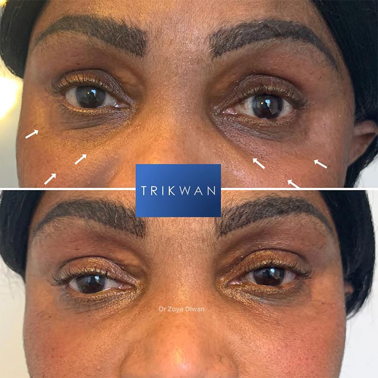 Under Eye Rejuvenation | TRIKWAN Aesthetics | Tired Eyes Treatment
