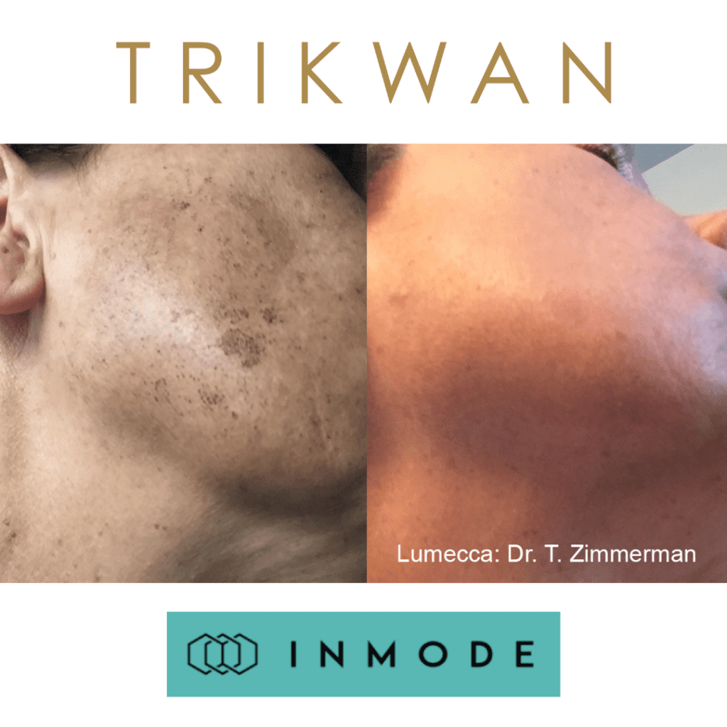 IPL - TRIKWAN Aesthetics - Harley Street & Mayfair London