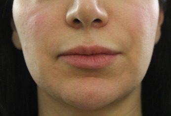 The Truth About Dermal Filler Migration: Understanding the Risks