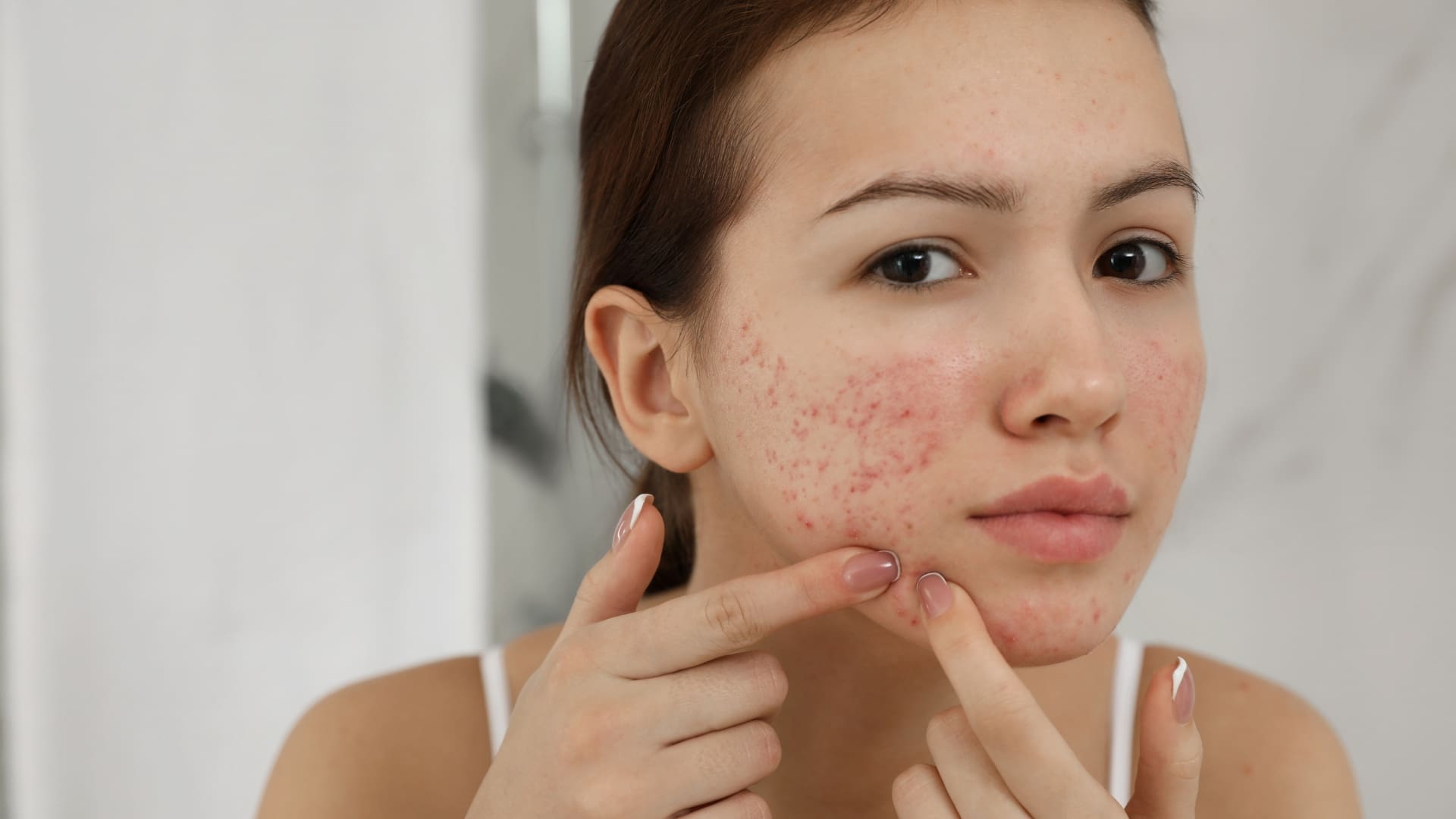 What are the best Acne treatments?